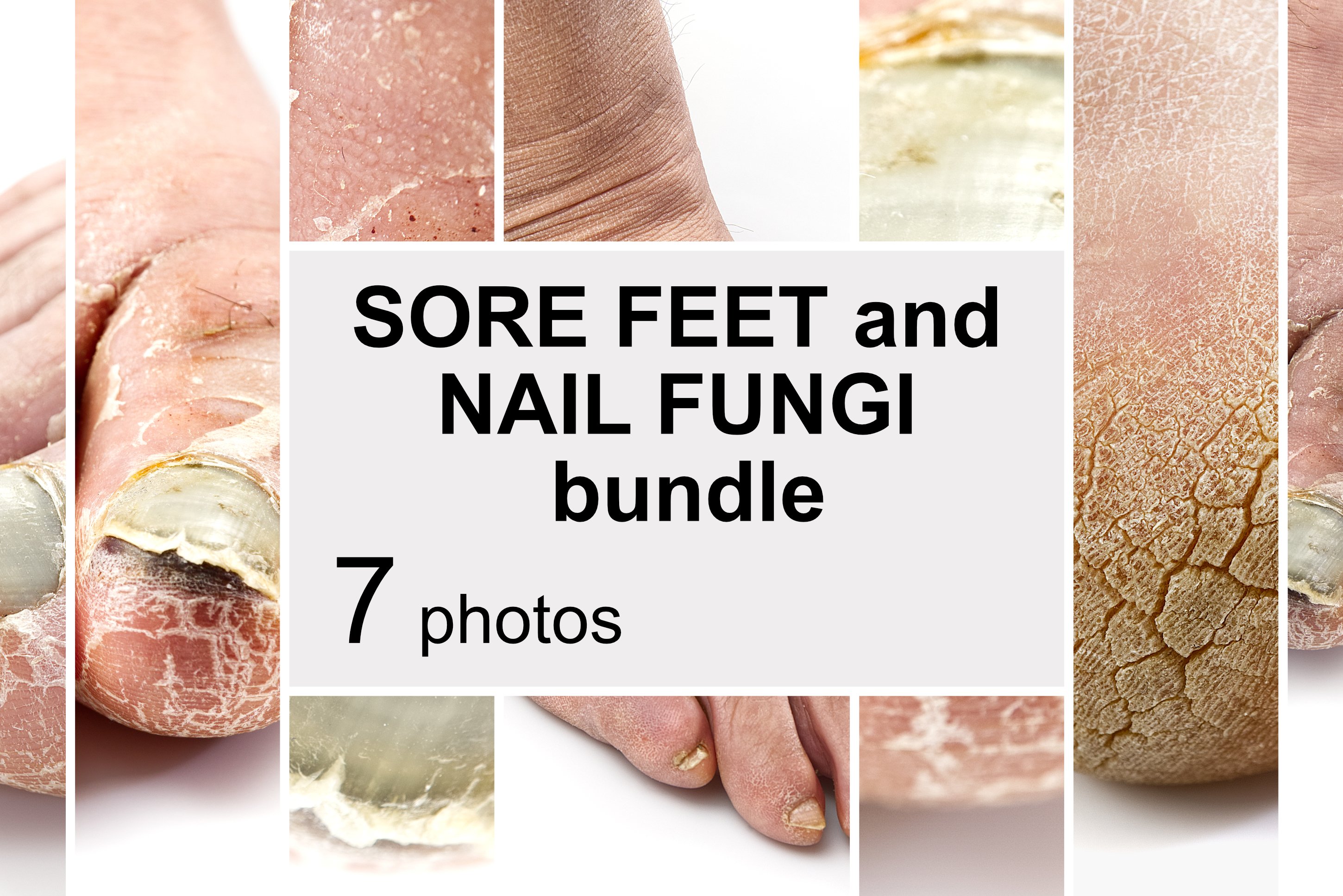 Bundle of Sore toenail, nail fungus. 7 Photos