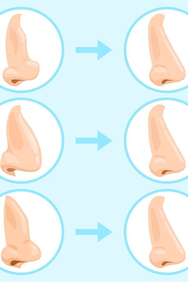 Cartoon rhinoplasty surgery. Rhinoplasty before (1341504)