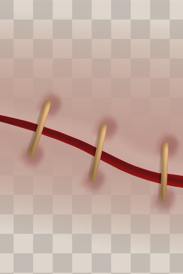 Realistic scar or wound. Bloody surgical sutures healing sti