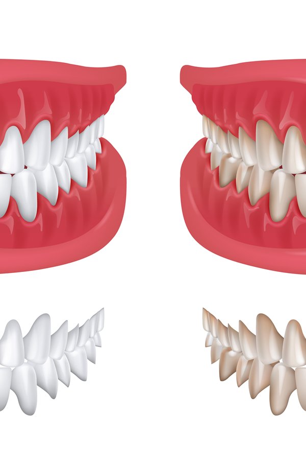 Realistic teeth. Isolated white 3D smile for orthodontics cl