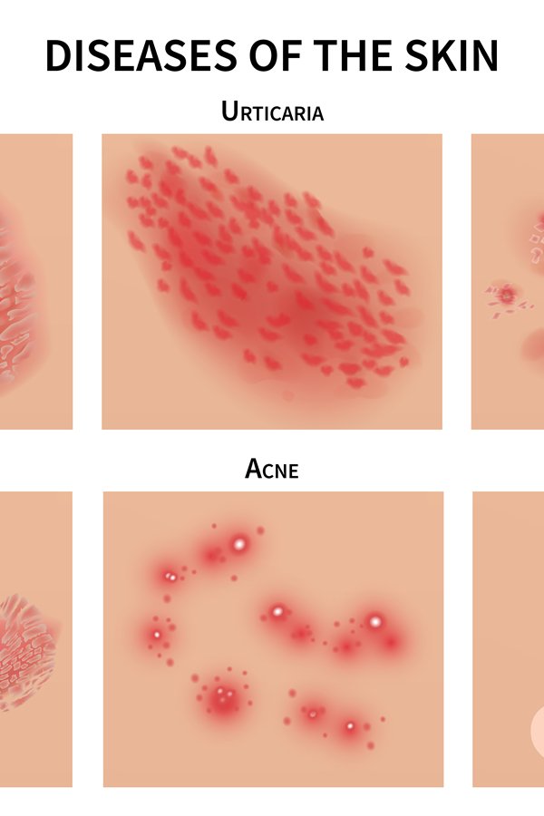 Skin diseases. Derma infection, eczema and psoriasis. Dermat