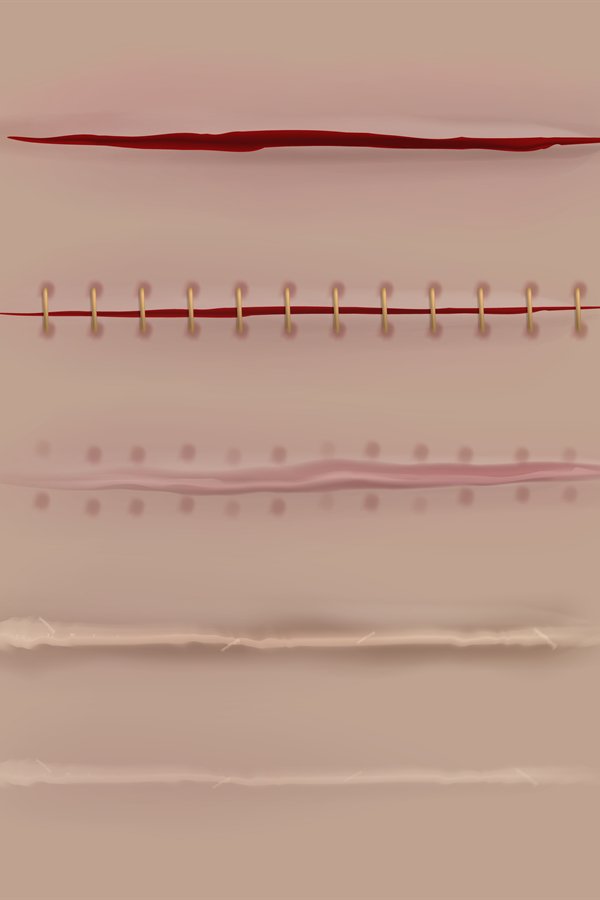 Surgical sutures healing stages. Realistic bloody wound and