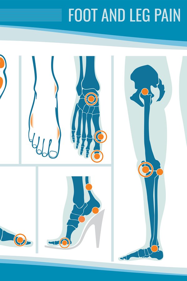 Foot and leg pain. Arthritis and rheumatism orthopedic medic