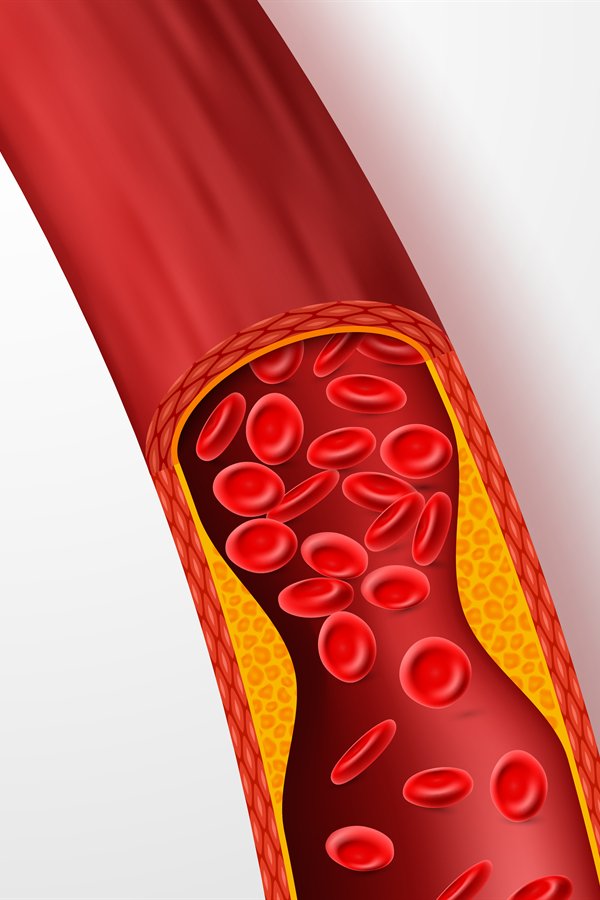 Blocked blood vessel, artery with cholesterol thrombus. 3d v