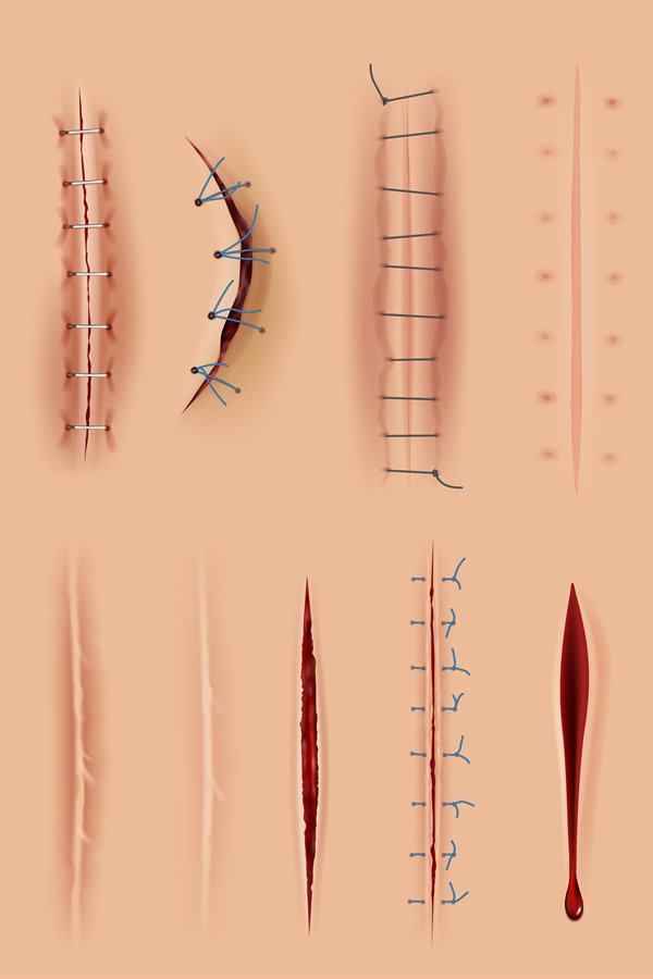 Realistic scars. Medical surgical sutures wounds close up pi