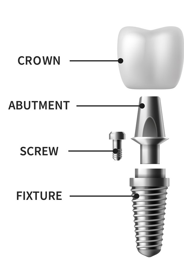 Tooth implant. Realistic dental implant structure, pictorial