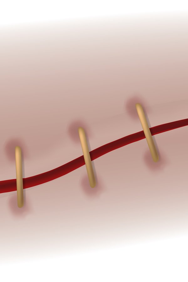 Scar or wound. Realistic bloody stitch. Surgical sutures hea