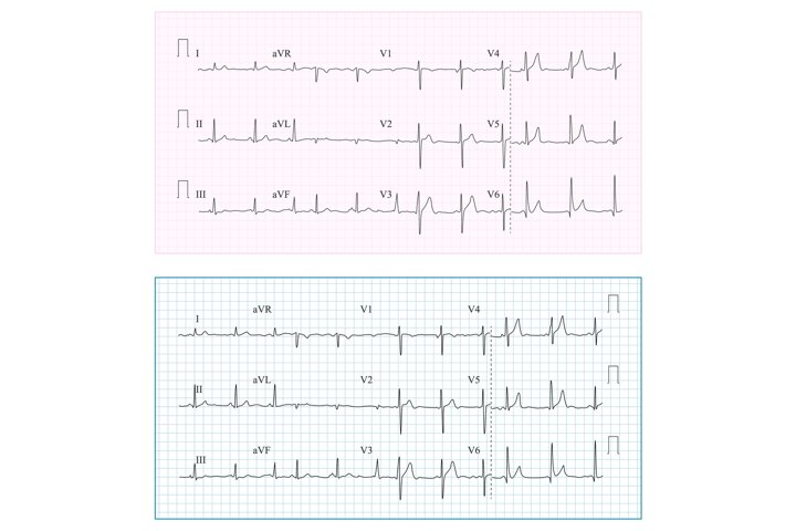 Heart Cardiogram Chart Vector. Set Healthy Heart Rhythm (677536 ...